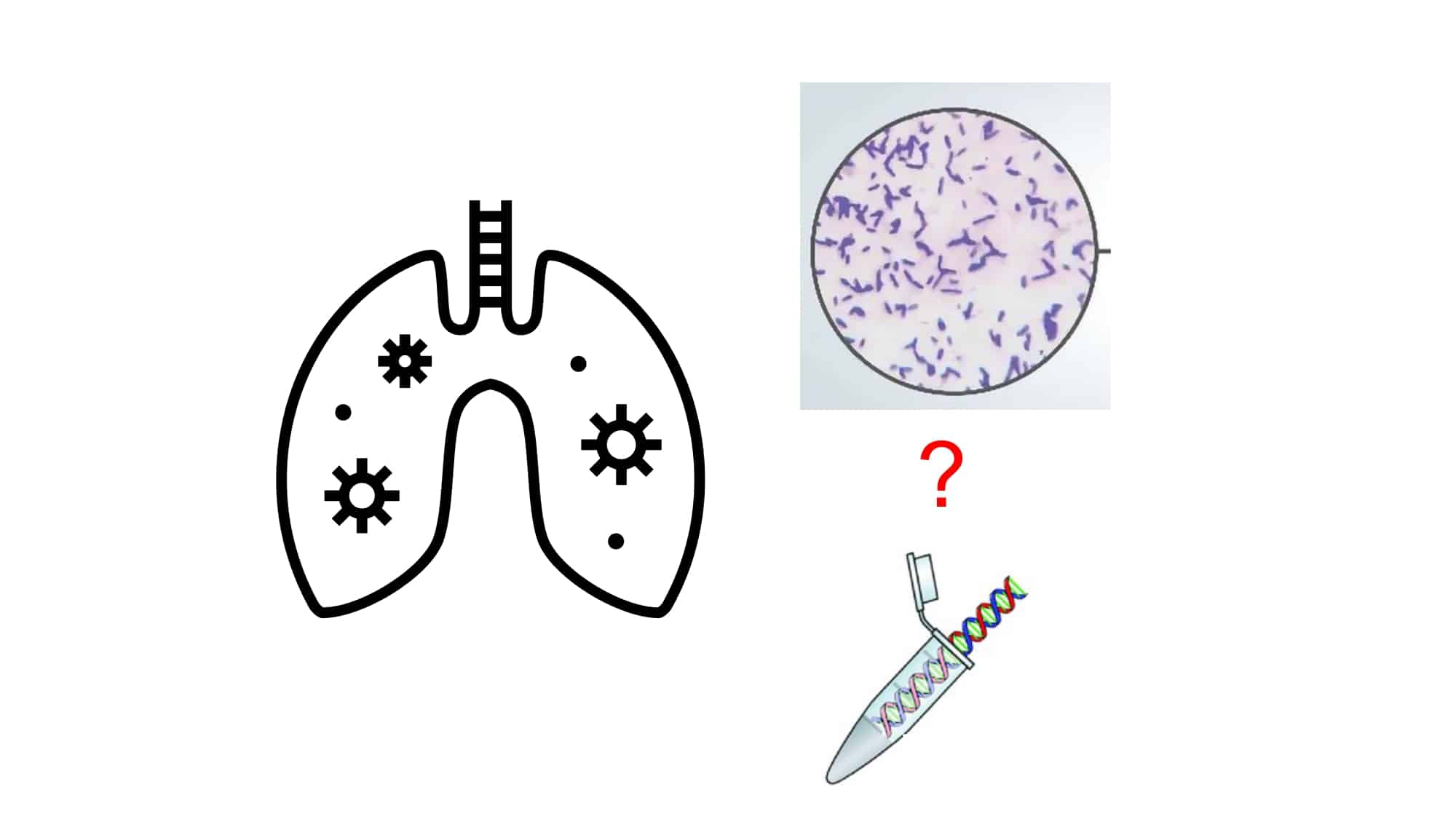 Fast multiplex bacterial PCR of bronchoalveolar lavage for antibiotic stewardship in ...